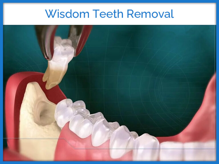 Wisdom Tooth Removal